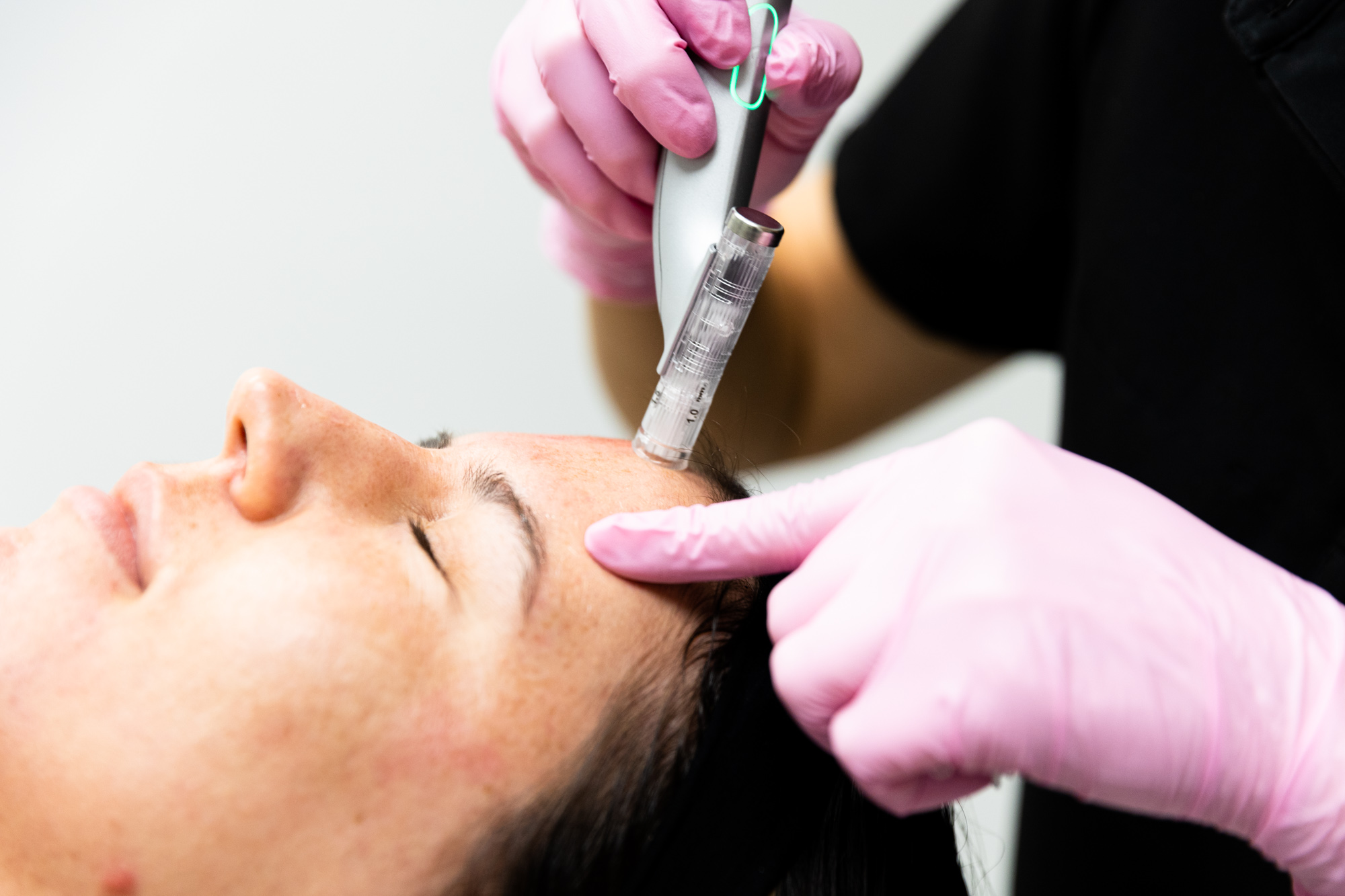 Microneedling in Oklahoma City | Bliss Medical Spa